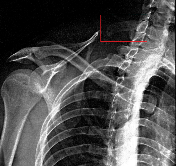 Sprengel Deformity X Ray