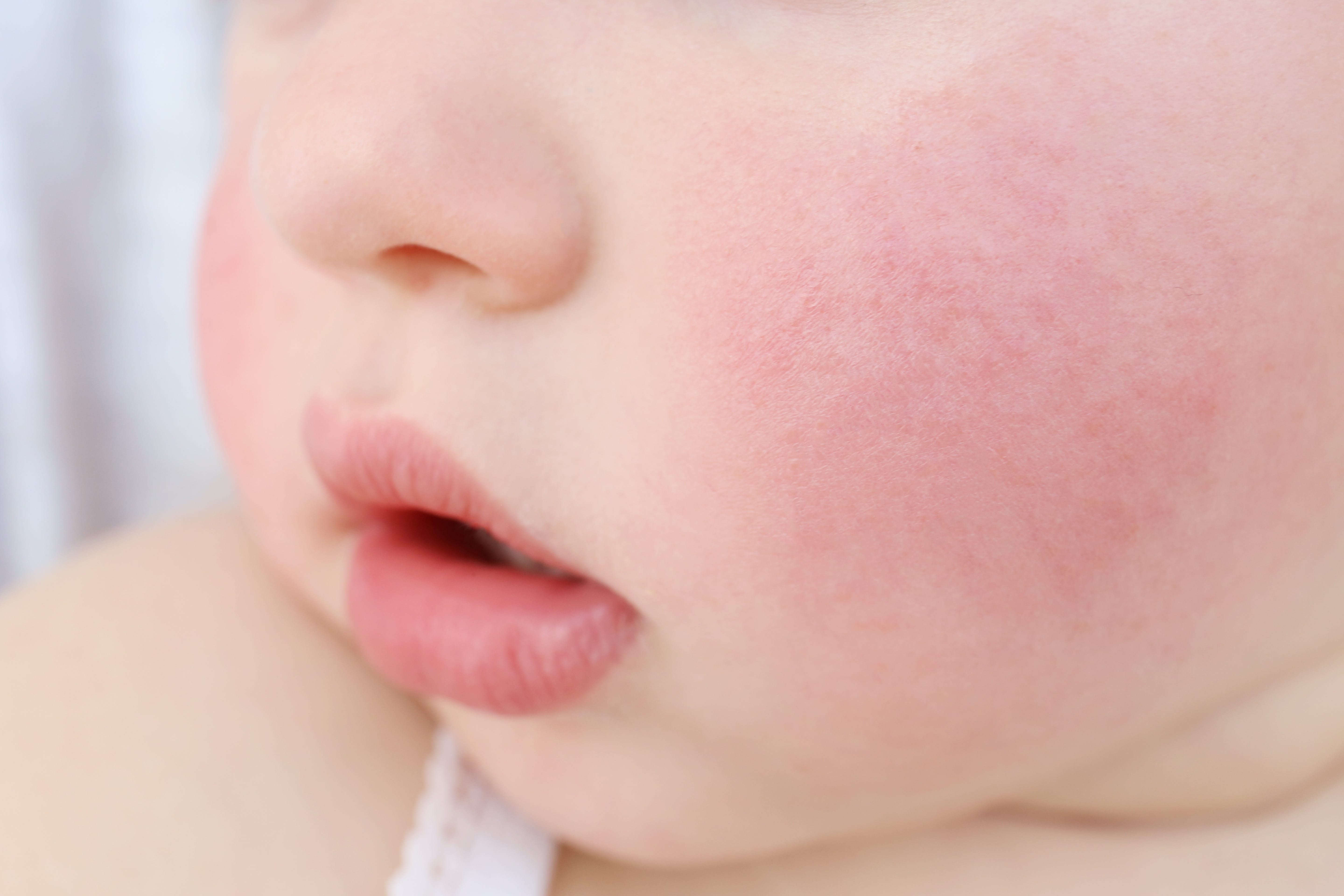 Baby Rash On Face Milk Allergy