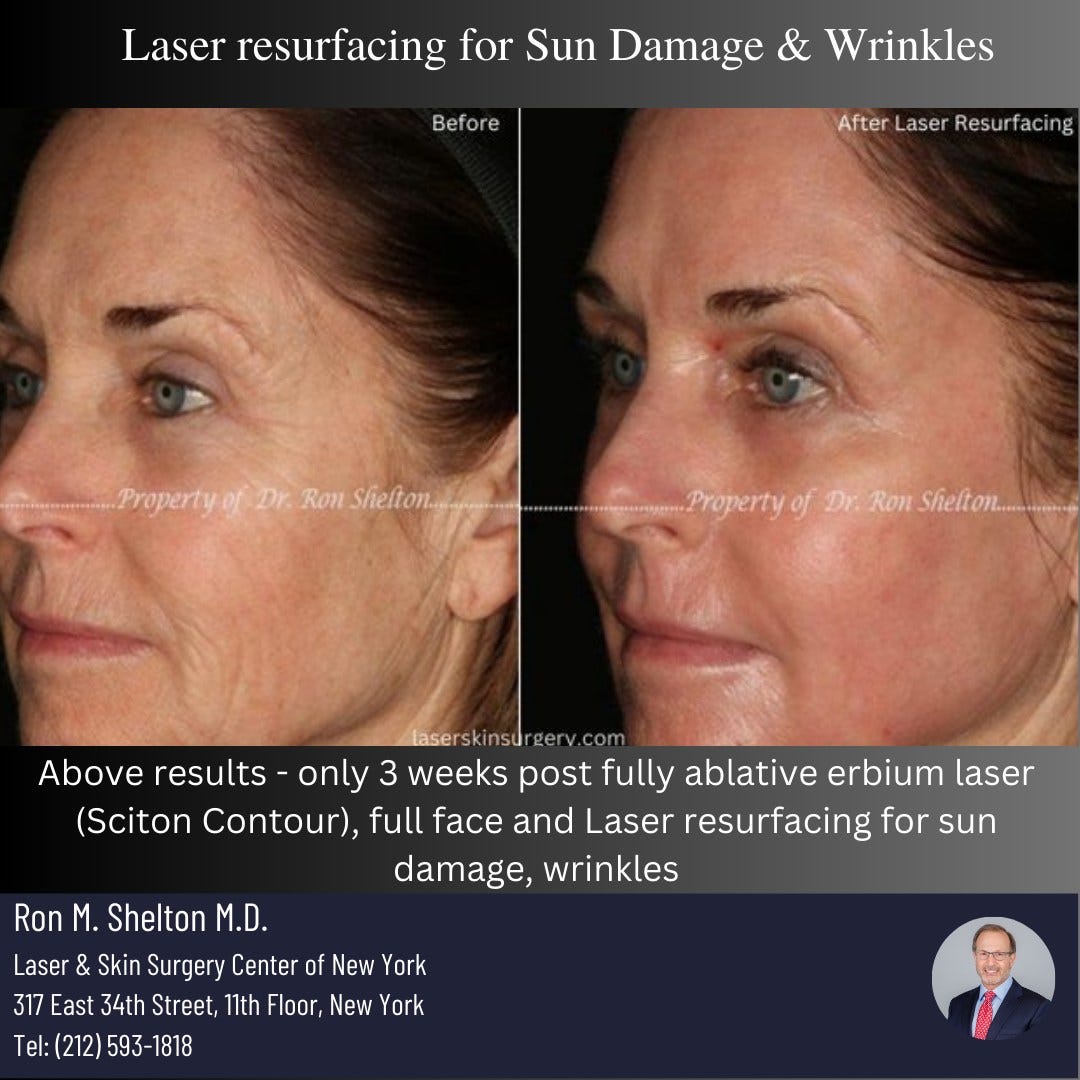 Wrinkled Skin From Sun Damage