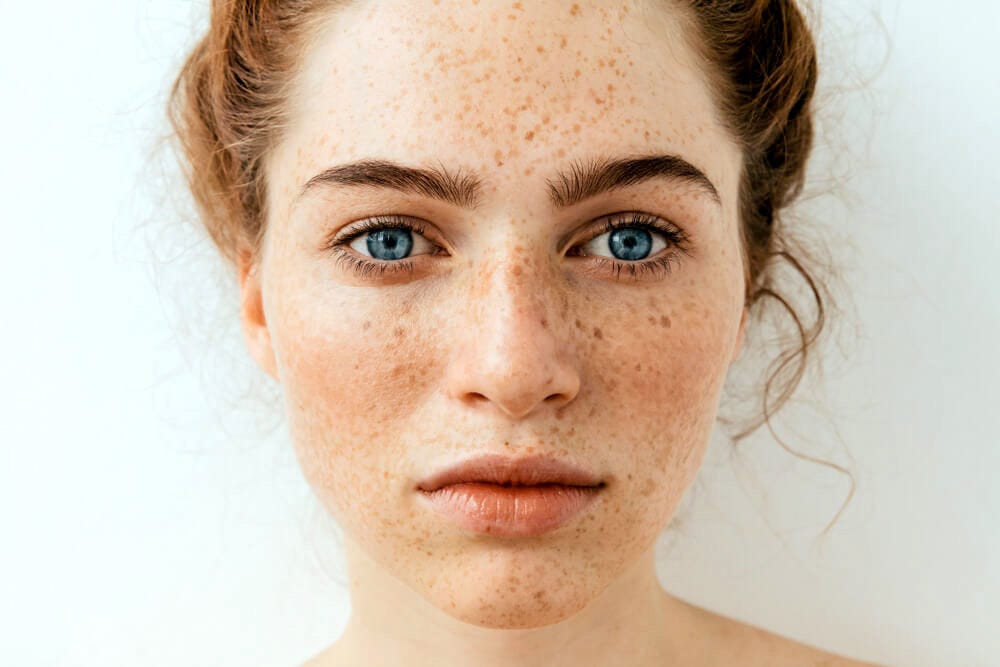 Best Treatment For Dark Spots On Face By Live Kaktus Medium
