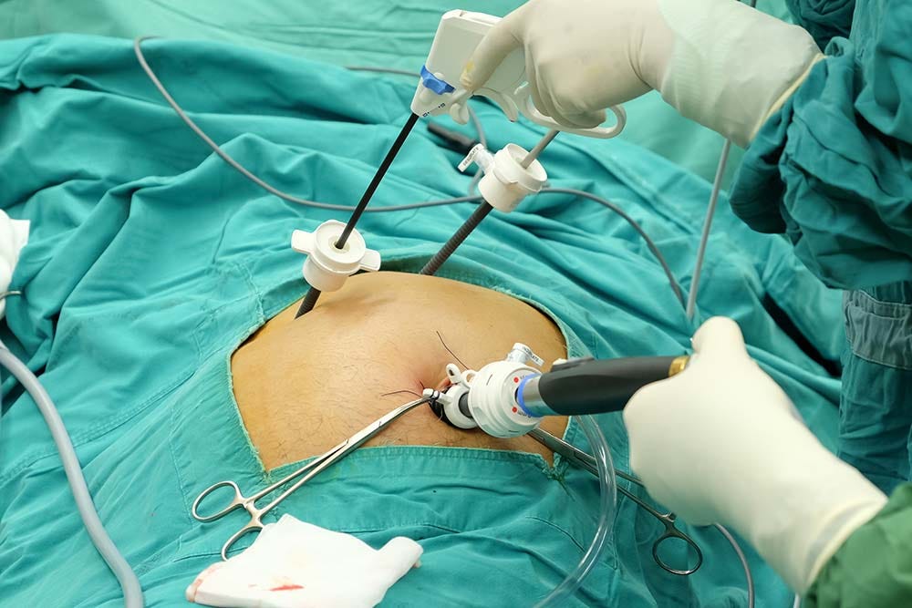 What Should You Know About Laparoscopic Gall Bladder Surgery By AB What Should You Know About Laparoscopic Gall Bladder Surgery By AB