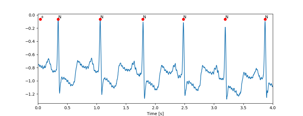 Machine Learning for medicine: QRS detection in a single channel ECG signal (Part 1: data-set ...