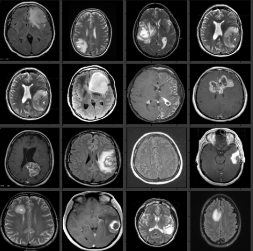 Brain Tumor Detection using FastAI and OpenCV | by Gayathri Shrikanth ...