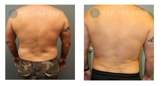 Liposuction in Columbus Ohio: A ROXY Plastic Surgery Testimonial | by ...
