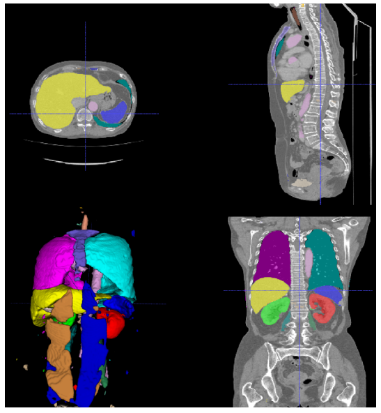 Review: Cascaded 3D U-Net — Multi-Organ Segmentation (Biomedical Image Segmentation) | by Sik-Ho ...