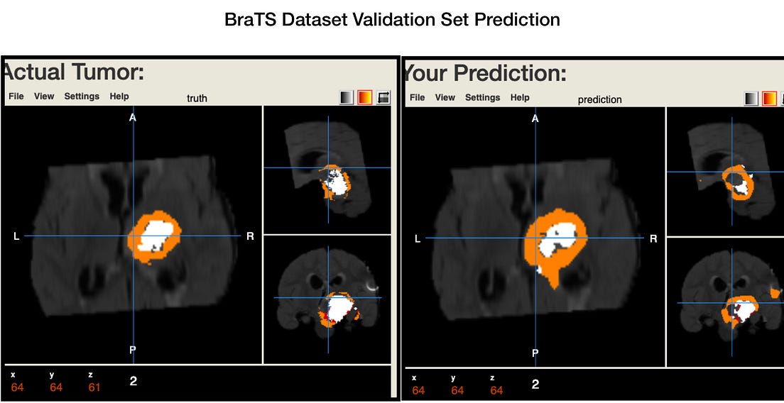 Brain MRI Segmentation using Deep Learning | by Abhijeet Khangarot ...