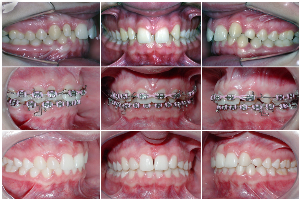 Diastema e Freio Labial Superior. As relações entre o Freio Labial ...