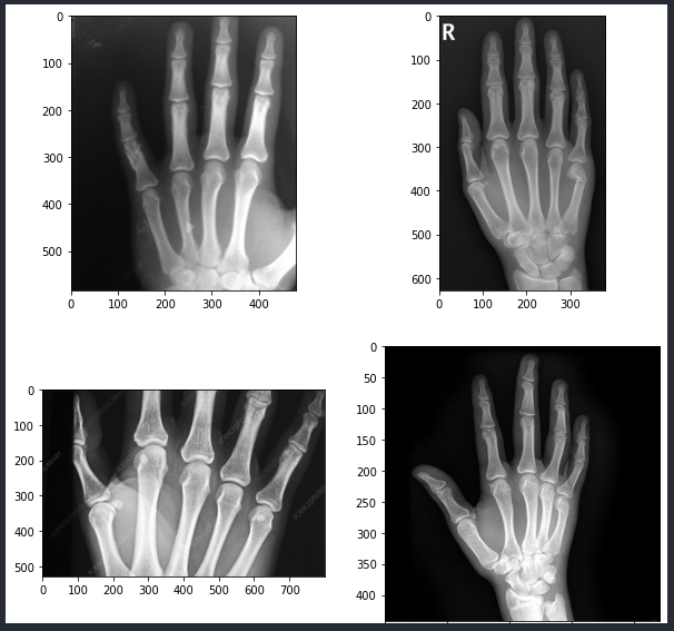 Computer Vision In Healthcare Detection Of Fractures By