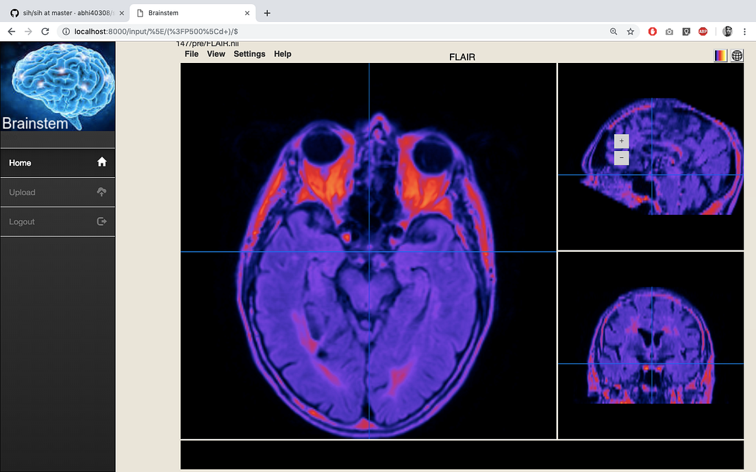 Brain MRI Segmentation using Deep Learning | by Abhijeet Khangarot ...