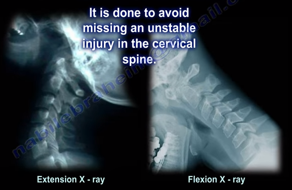 Cervical Spine Instability, Flexion Extension X-rays | by Nabil ...