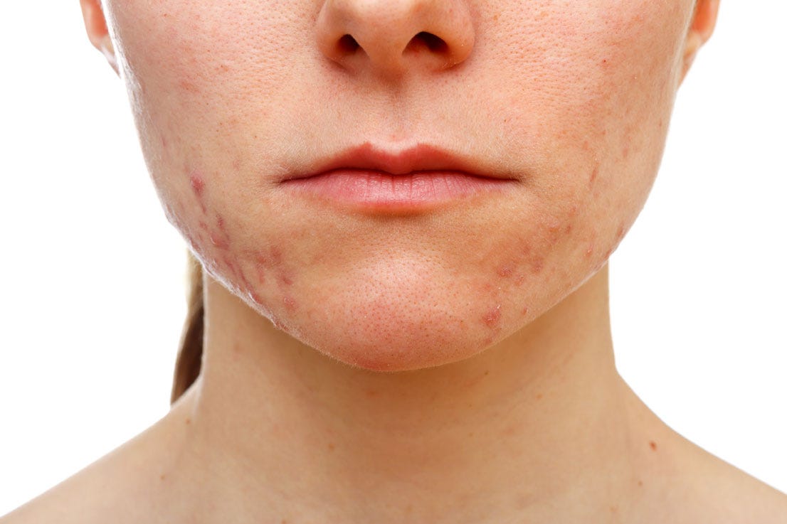 How To Have Beautiful Acne Free Skin All Season? - Alessia johnson - Medium