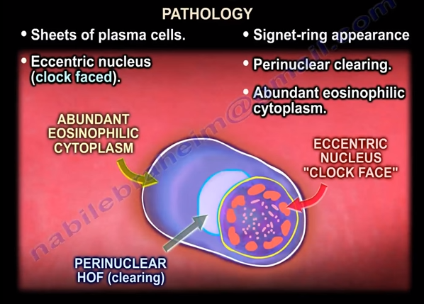 Multiple Myeloma. Multiple myeloma is a cancer and… | by Nabil Ebraheim ...