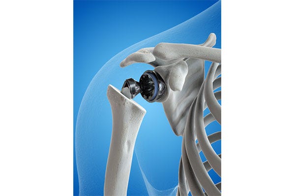 Everything to Know About Total Shoulder Replacement: Surgery to Therapy ...