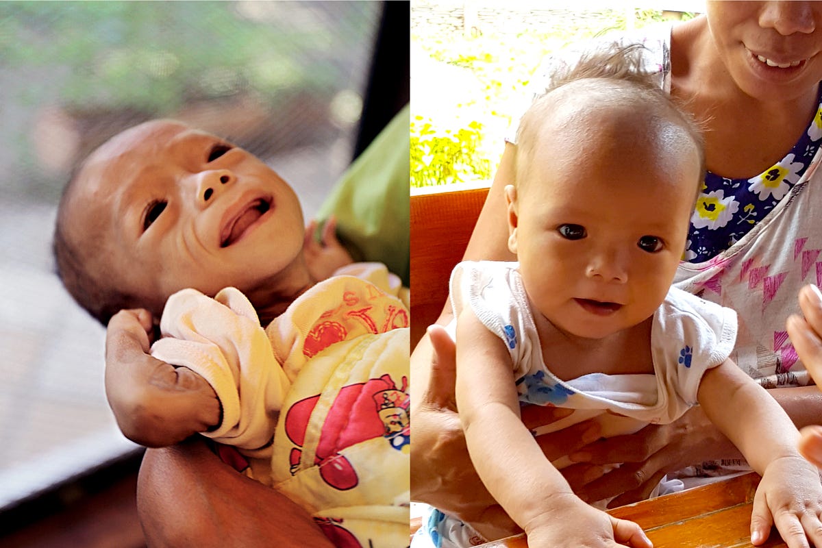 Treating Filipino children with severe malnutrition | by UNICEF ...