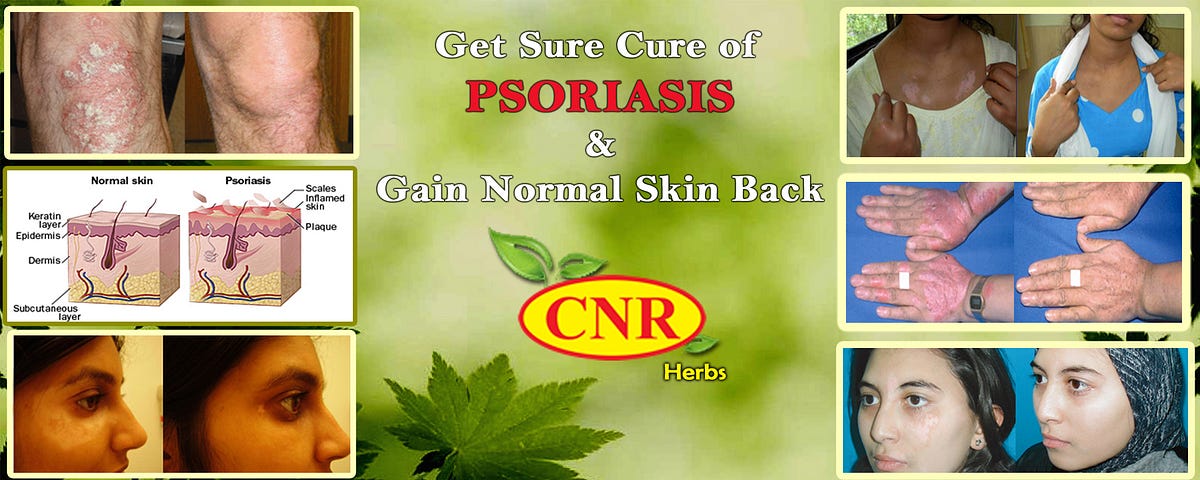 Home Remedies for Psoriasis By Cnr Herbs | by CnrHerbs | Medium