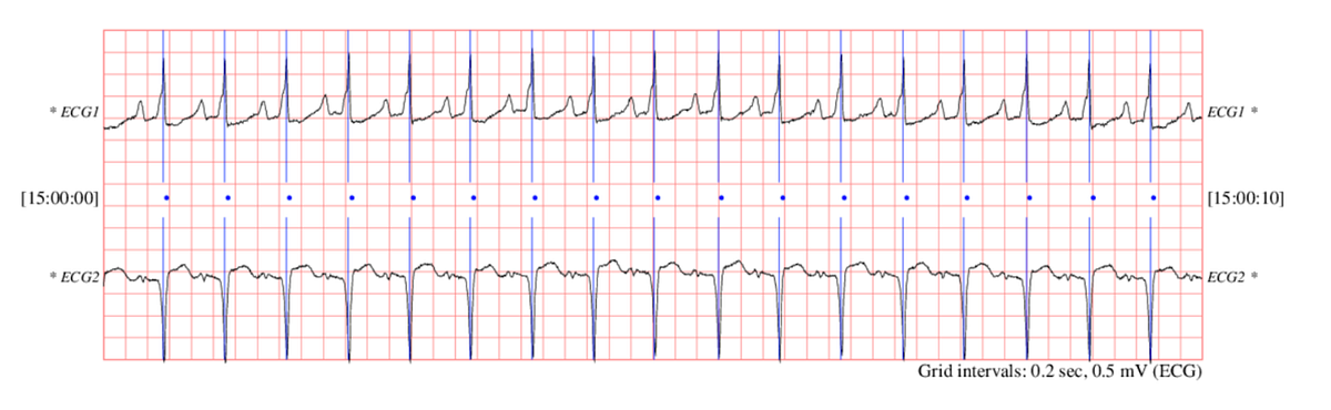 Atrial Fibrillation Classification Using Machine Learning By Anan Methasate Towards Data Science