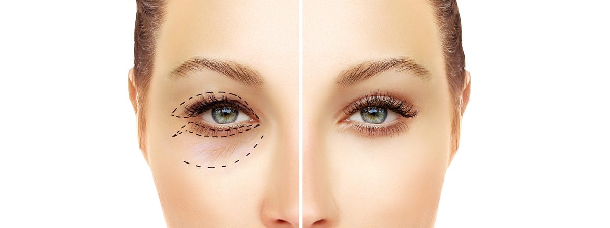 Eyelid Muscle Surgery In Parrsboro | by Priya Sharma | Medium