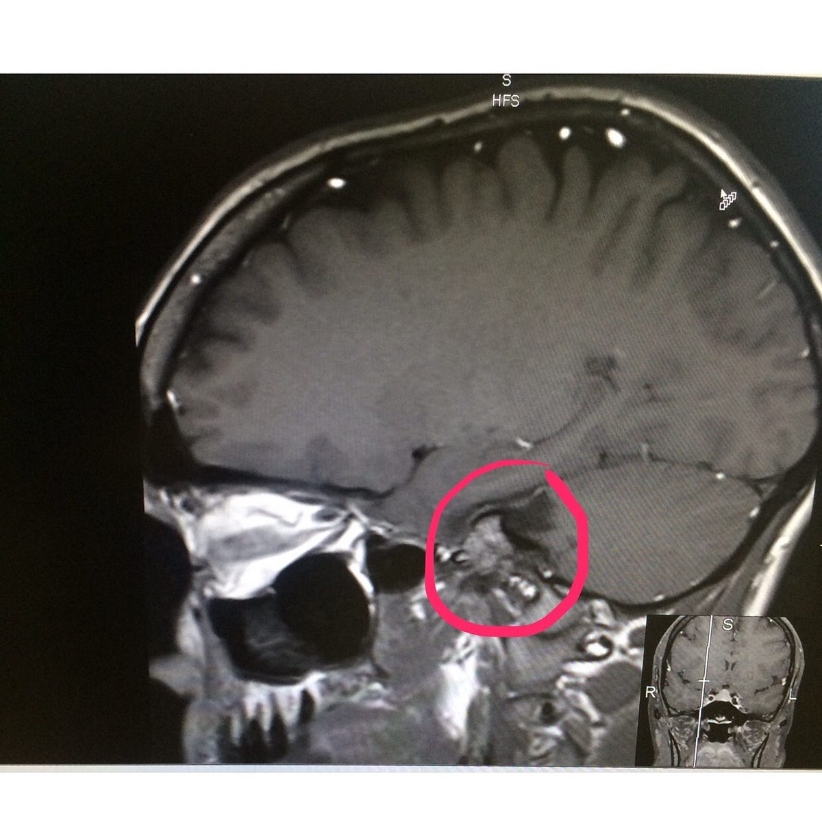 My beautiful, broken brain.. My beautiful, broken brain | by Amber ...