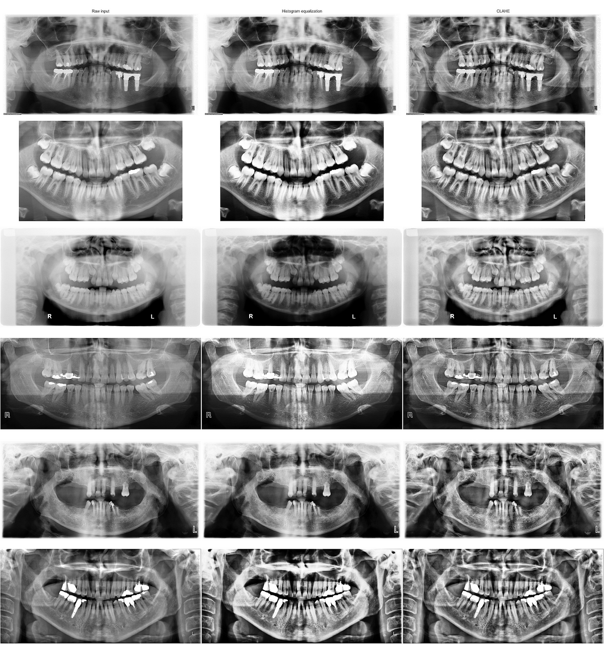 Improving Deep Learning Object Detection On Dental X Rays