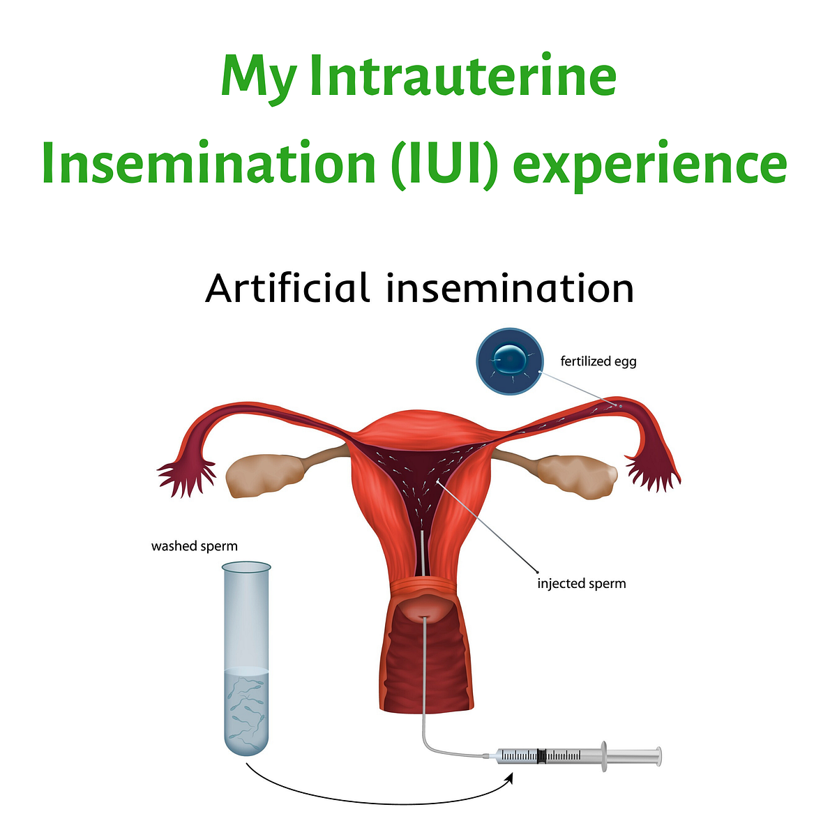 Step by step Intra Uterine Insemination (IUI) experience. | by Shayo ...