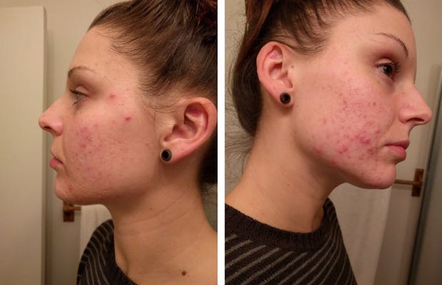 Acne Treatment Progress Photos | by My Acne Journey | Medium