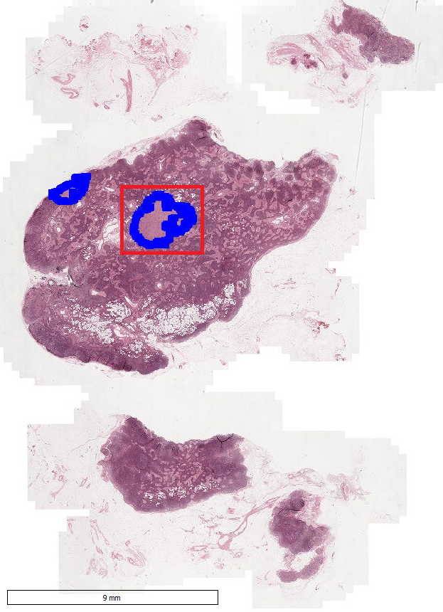 Histopathological Images of Cancer Cells — Image Classifier | by abhik ...