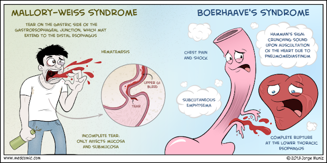 Boerhaave Syndrome / Oesophageal Rupture | by Pasindu Suriapperuma | Medium