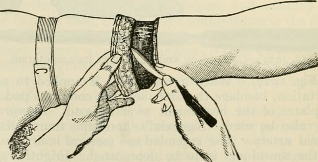 A Briefing on Civil War Amputations | by Kayla Desroches | Parts ...
