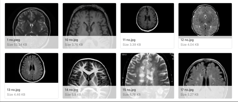 Brain Tumor Detection using FastAI and OpenCV | by Gayathri Shrikanth ...