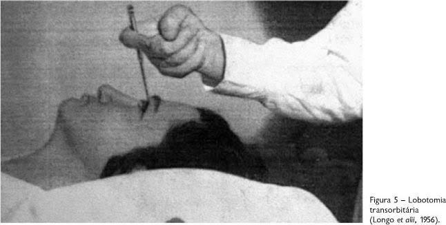 O Horror da Lobotomia. Quando os procedimentos médicos e… | by Claudio Roberto dos Santos | Medium