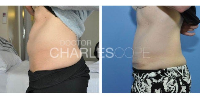Here’s Why Laser Liposuction Is The Best Solution To An Instantly ...