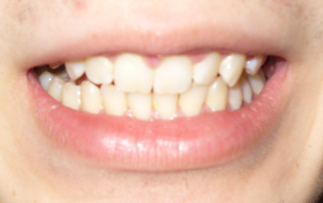 How To Save Thousands On Braces And Get a Beautiful Hollywood Smile ...