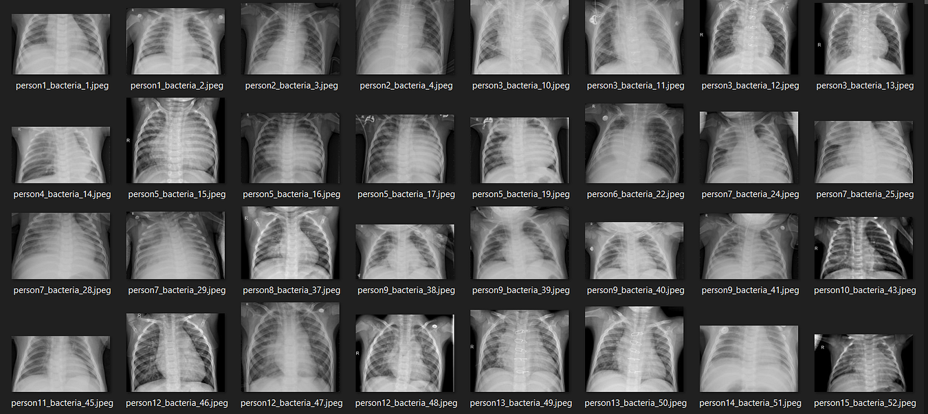 How Does Pneumonia Detection Using Cnn Work In Python 7219
