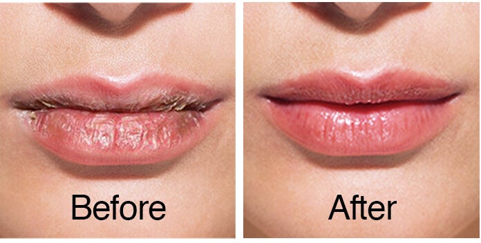 This Is How You Can Get Soft Lips In 5 Easy Ways By Jyothsna