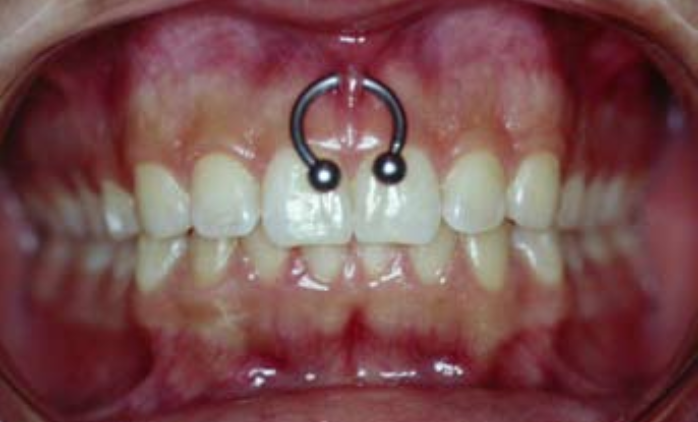 Diastema e Freio Labial Superior. As relações entre o Freio Labial ...