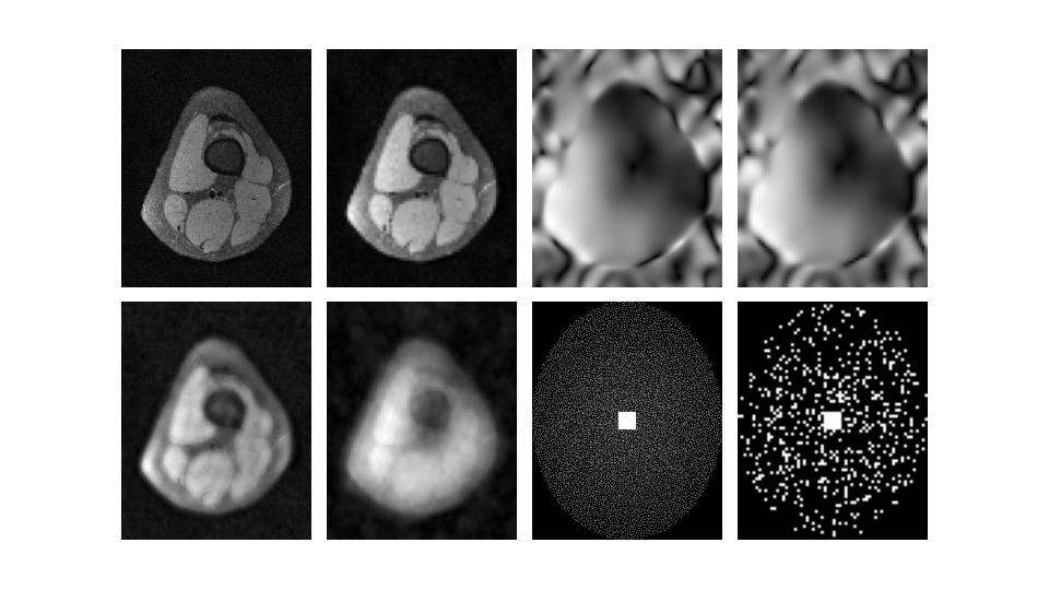 Improving Undersampled MRI with Deep Learning | by Menelaos Kaskiris ...