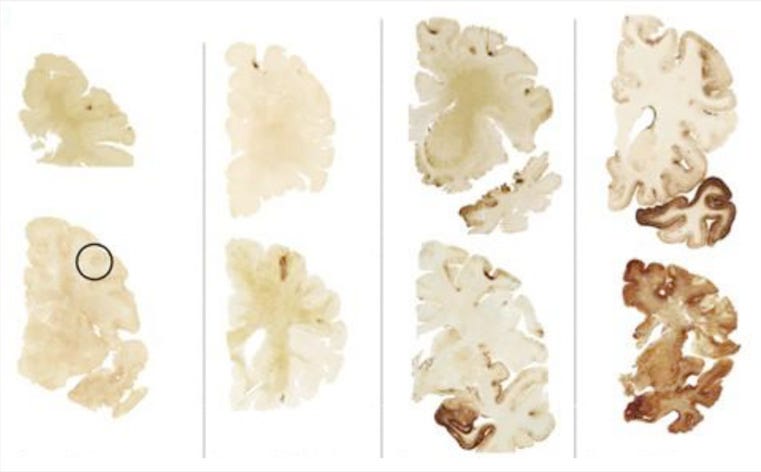 The Dangers of Head/Brain Injuries and CTE in the NFL | by Reid Huebert ...