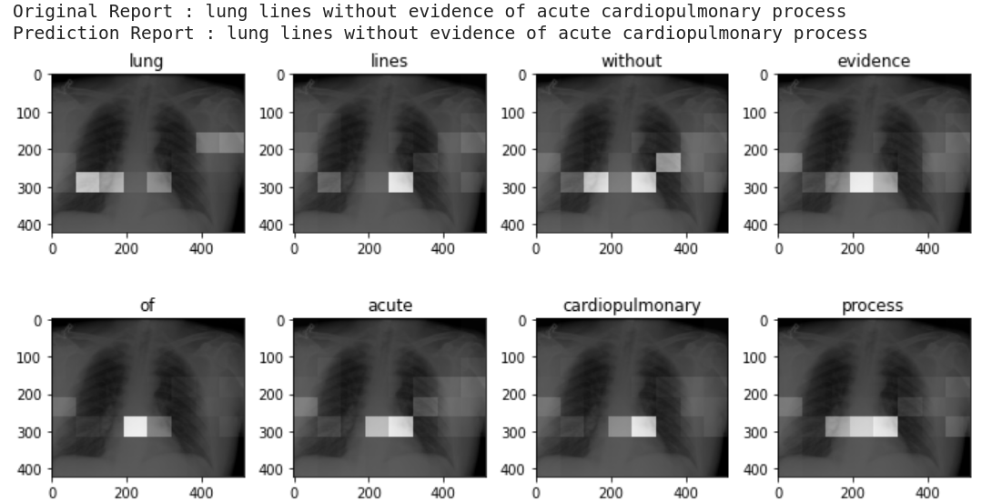 Medical Report Generation Using Chest X-rays — Self Case-Study | by ...