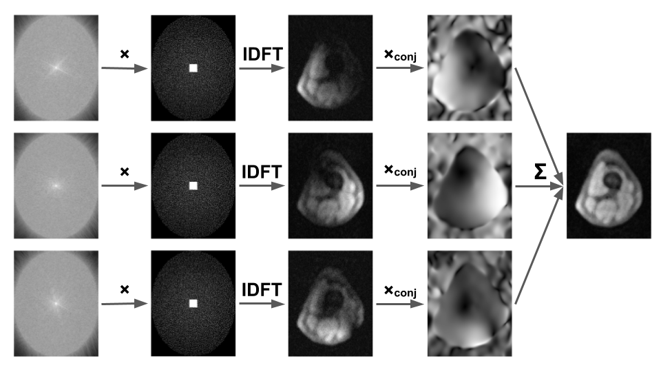 Improving Undersampled MRI with Deep Learning | by Jackson Lightfoot ...
