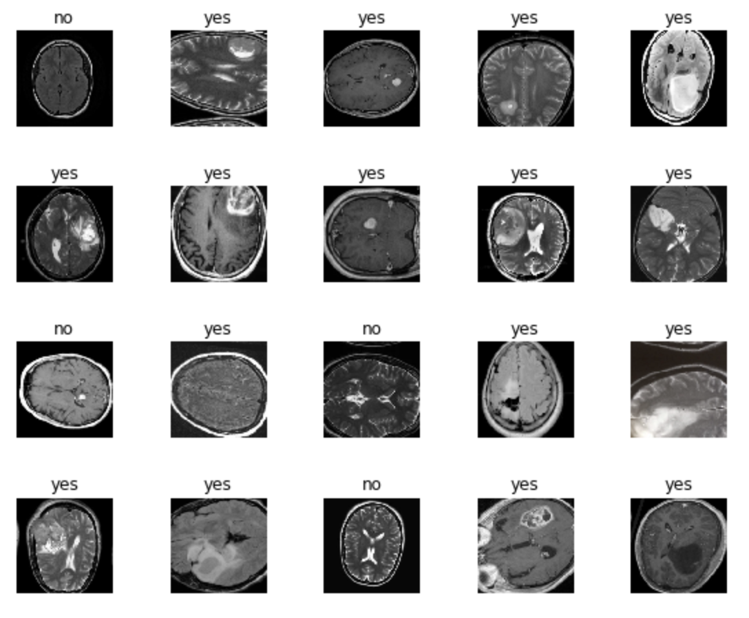 Brain Tumor Detection using FastAI and OpenCV | by Gayathri Shrikanth ...