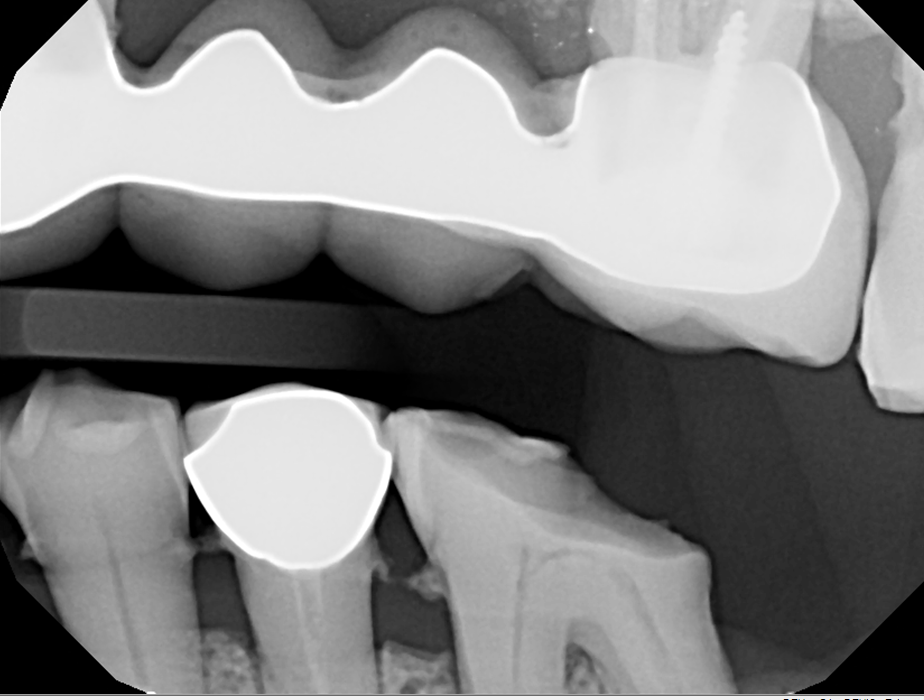 Mandibular Molar Missed Canals. Well, here is a moment that I’m… | by ...
