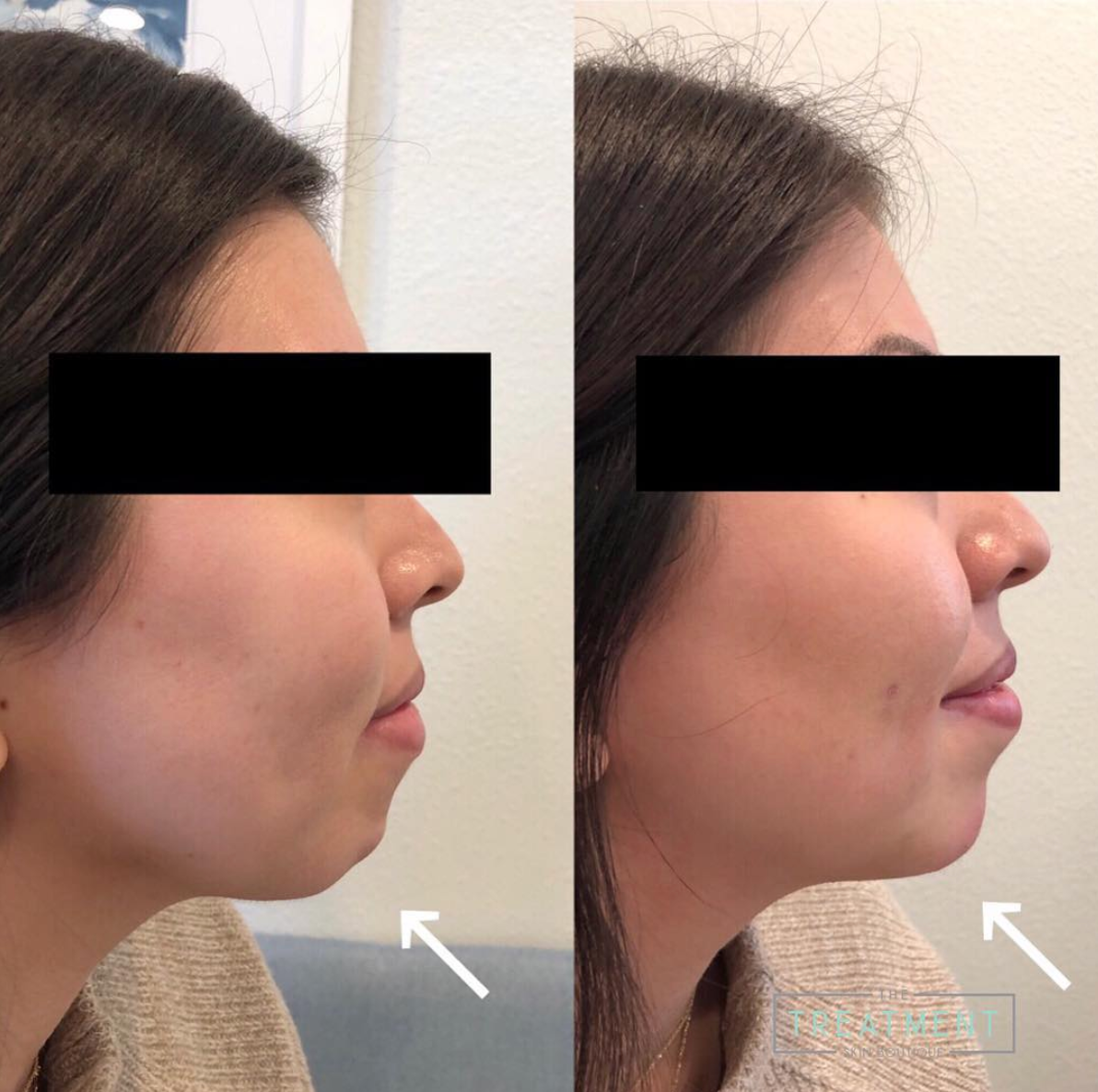 I got chin filler & TBH it was so worth it | by Caitlin Belardes | Medium