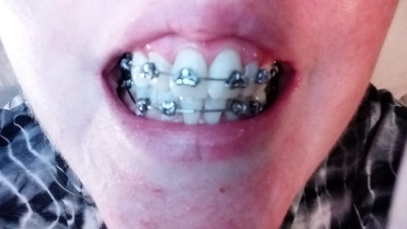 FAST BRACES Part 2 of the story… First…ouchhhh. I got my second batch ...