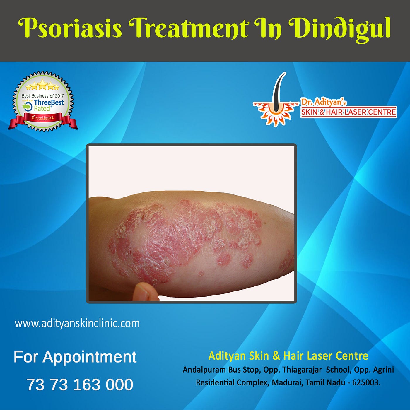 What Does It Look Like When You Have Psoriasis? | by Serin Max | Medium