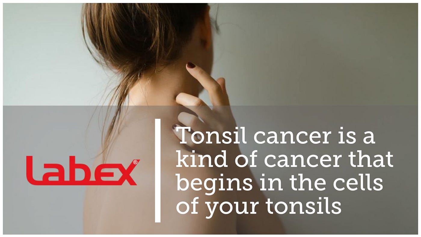 Tonsil cancer is a kind of cancer that begins in the cells of your ...