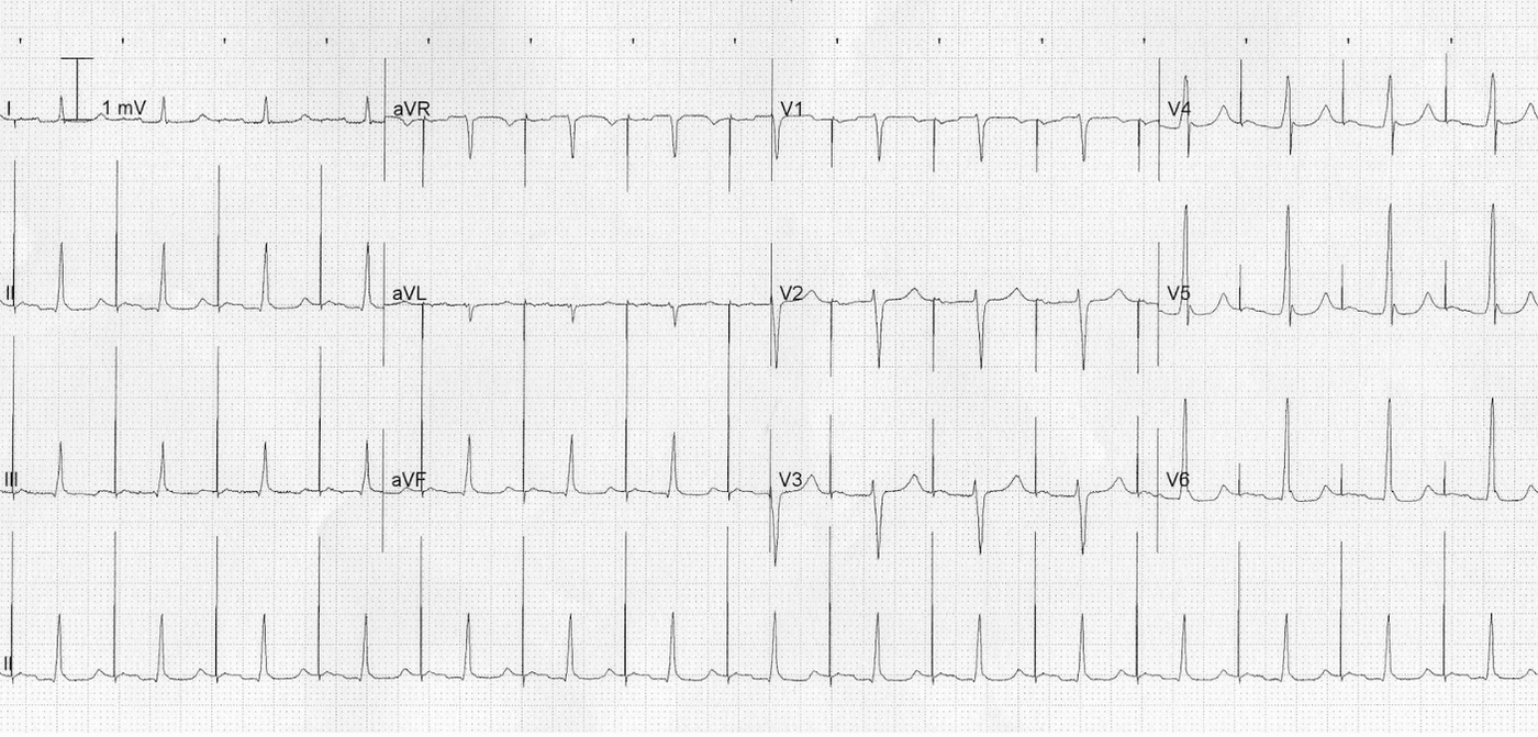 Pacemaker 101. I haven’t been apart of the medical… | by Tiffany Trinh ...