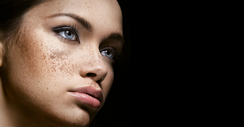 Melasma: quais as causas e como tratar as manchas escuras que aparecem ...