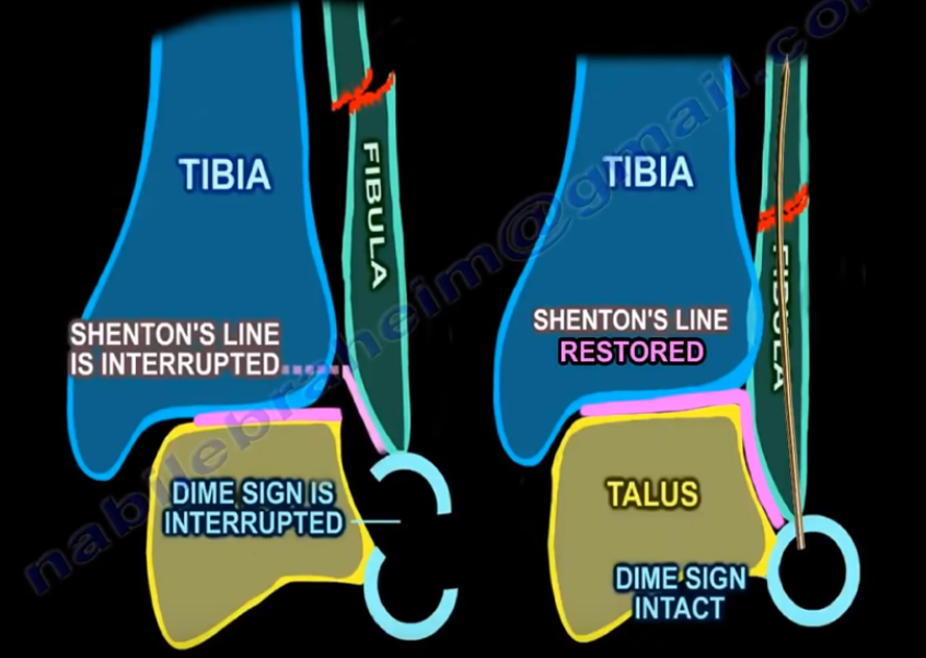 Ankle Fractures. Minimally Invasive Fixation | by Nabil Ebraheim | Medium