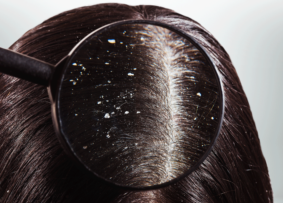 How to get Rid of Dandruff. Dandruff Control can help you step out ...
