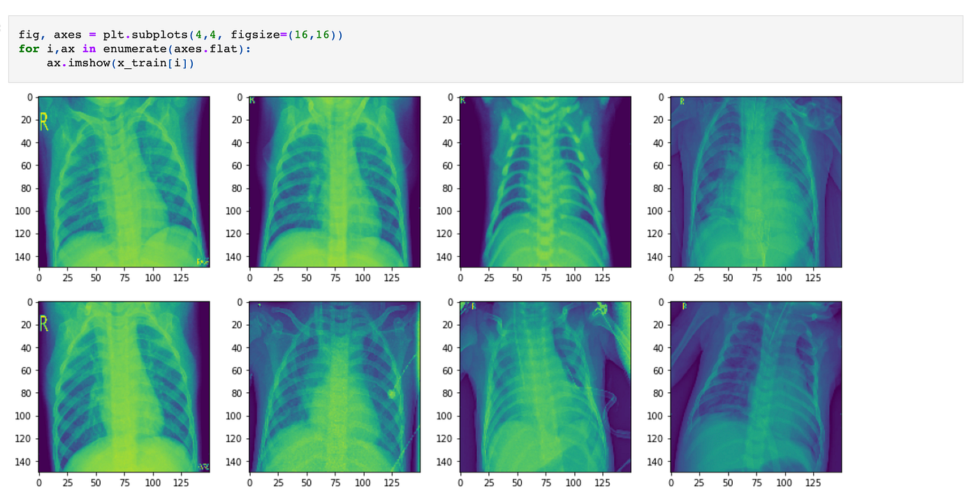 AI with Ali: Pneumonia Detection using Deep Learning & X-Ray Images ...